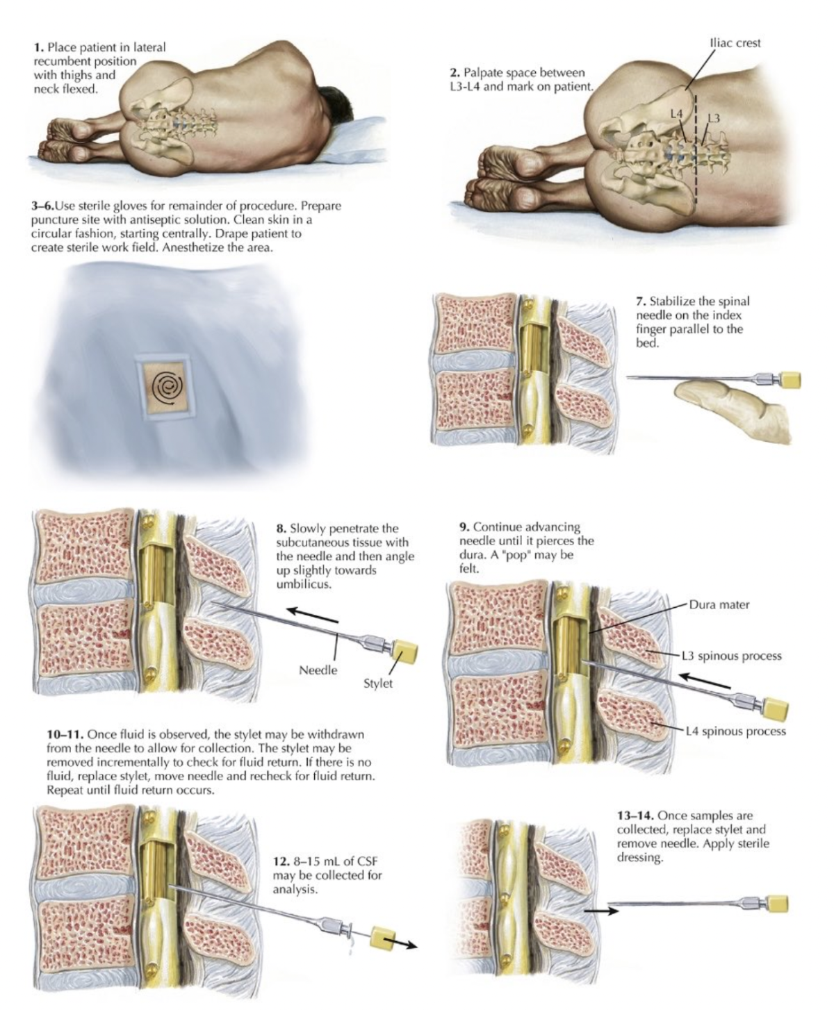 Cerebrospinal fluid - main abnormalities - Wikimedicine