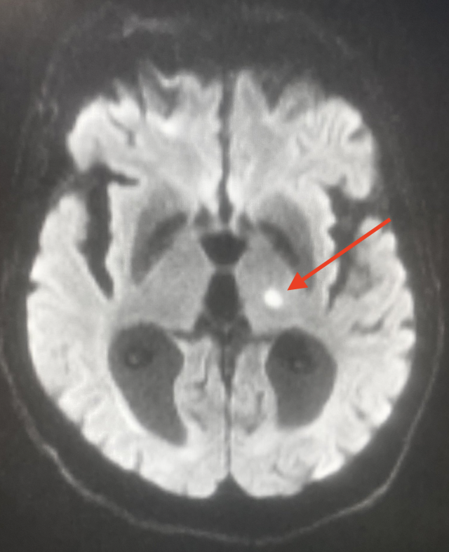 Ischemic cerebral lacunae - lacunar infarcts - Wikimedicine